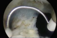 China Radio Frequency Plasma Surgical Electrodes For BPH And Other Urology Diseases for sale