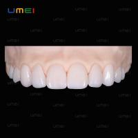 China Durable Whitening Porcelain Veneers , High End Transparent Dental Clinic Veneers for sale