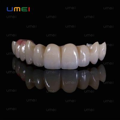China Malo Bridge-Removable Crowns-Natural Aesthetics for sale