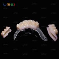 China Biocompatible Titanium Marlow Bridge Dental Full Arch Restoration for sale