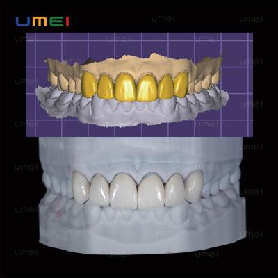 China Digital Anterior Aesthetic Restoration-Natural Aesthetic Harmony-Precision Fabrication for sale