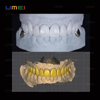 China Digital Implant-Supported Anterior Restoration-Natural Aesthetic Integration-Implant-Focused Digital Planning for sale