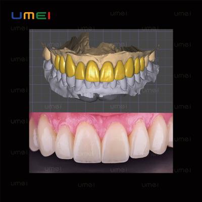 China Digital Anterior Aesthetic Restoration -Digital Diagnostic Wax-Up-Digital Diagnostic Wax-Up for sale