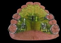 China Mouthpieces Dental Tooth Orthodontic Appliances , Orthodontic Ligature Ties for sale