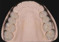 China Dental Restoration Teeth Zirconia dental Crowns crafted by china dental lab for sale