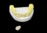 China Custom Made Dental Ceramic Inlays and Onlays for Restorative Solutions and Repair of Damaged Teeth for sale