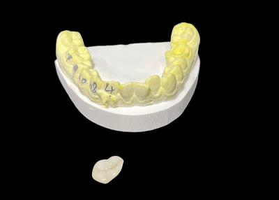 China Custom Made Dental Ceramic Inlays and Onlays for Restorative Solutions and Repair of Damaged Teeth for sale