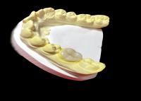 China High-Quality Ceramic Inlays and Onlays for Seamless and Long-Lasting Tooth Restoration for sale
