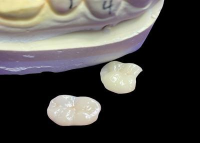 China IPS e.max Ceramic Inlays and Onlays for Molar Restoration Natural Aesthetic and Superior Durability for Long-Lasting Results for sale
