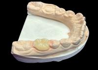 China Custom Smooth Dental Ceramic Inlay for Staining Resistant Seamless Tooth Repair and Natural Aesthetic for sale
