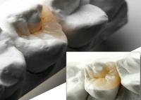 China Natural Looking Ceramic Inlays and Onlays for Precise Dental Restoration from Our Expert Dental Lab for sale