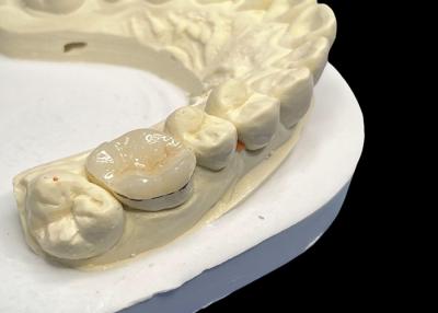 China Hypoallergenic Porcelain Inlays Onlays for Teeth Repair Natural Color and Easy Maintenance for sale