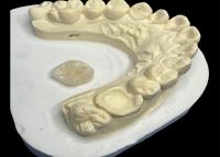 China Ceramic Dental Inlay Onlay for Effective Teeth Repair with Durable and Aesthetic Porcelain Solutions for Long-Lasting Restoration for sale