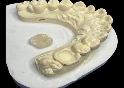 China Ceramic Dental Inlay Onlay for Effective Teeth Repair with Durable and Aesthetic Porcelain Solutions for Long-Lasting Restoration for sale