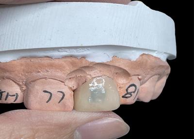 China EMAX Veneers Transform Your Smile with Highly Translucent Natural Looking Teeth for sale