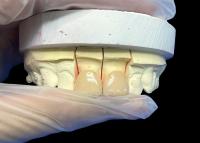 China Precision Strength EMAX Porcelain Veneer incisor for Natural looking Aesthetic Restorations for sale