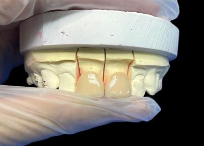 China Precision Strength EMAX Porcelain Veneer incisor for Natural looking Aesthetic Restorations for sale