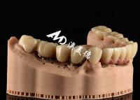 China Functional Aesthetic Dental Implant Crown Bridge – Precision and Durability for sale