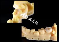 China Precision Ceramic Inlays and Onlays for Teeth Repair with Natural Color Hypoallergenic Material and Seamless Fit for Superior Comfort and Durability for sale