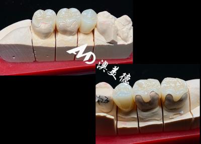 China OEM Precision Fit Ceramic Inlays Onlays for Durable and Natural-Looking Dental Restorations with Superior Strength and Reliability for sale