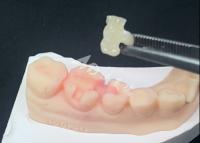 China Emax Ceramic Inlays Onlays Dental Restorations For Natural Tooth Color for sale