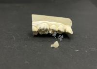 China Stain-Resistant Emax Ceramic Inlay for Accurate Repair of Damaged Teeth for sale