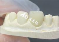 China Durable and Aesthetic EMAX Veneer The Perfect Solution for sale