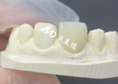 China Durable and Aesthetic EMAX Veneer The Perfect Solution for sale