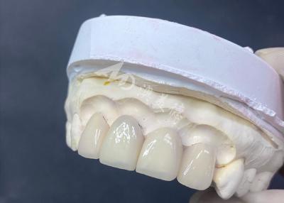 China Precision-Crafted Dental Veneers Excellent Fit and High Translucency for Flawless Smile for sale