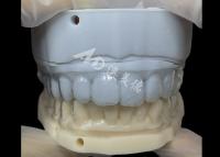China Orthodontic retainer　Essix Retainer Simple And Versatile Correction for sale