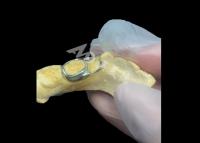 China Orthodontic Space maintainer an invaluable device ingeniously guarding children's tooth gaps ensuring proper tooth development. for sale
