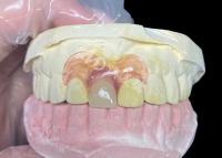 China Nesbit flexible partial denture for incisors offering a seamless removable tooth replacement solution for sale