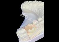 China IPS e.max Ceramic Inlays and Onlays for Molar Restoration with Durable Aesthetic and Natural Looking Results for sale