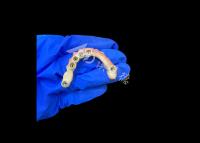 China Titanium Abutment and Zirconia Crown Implant Supported Dentures Precision Fit for Comfortable Wear for sale