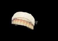 China Implant Supported Dentures Stability Comfort and a Natural Smile for sale