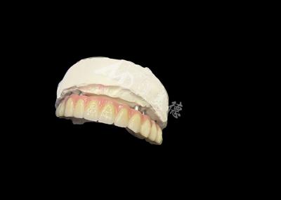 China Implant Supported Dentures Stability Comfort and a Natural Smile for sale