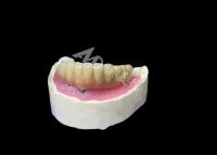 China Implant Supported Dentures Stability Comfort and a Natural Smile for sale