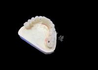China Implant Supported Dentures Stability Comfort and a Natural Smile for sale