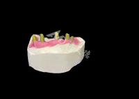 China Implant Supported Dentures Stability Comfort and a Natural Smile for sale