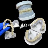 China PMMA Provisional Implant Bridge with Hollow Inside for Stability and Natural Healing, High-precision CAD/CAM Fabrication, Biocompatible PMMA Material for sale