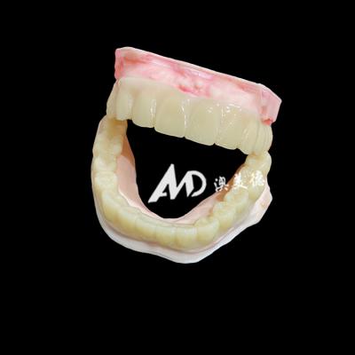 China Lightweight PMMA Temporary Bridges with Hollow Design for Implant Restorations for sale