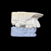 China Achieve Precise Arch Expansion with Our Orthodontic Expander with Molar Bands for sale