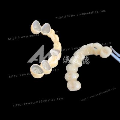 China Excellent Biocompatibility Porcelain Fused To Metal Crown Secure Bonding Natural Looking Aesthetic Durable Dental Crown for sale