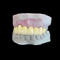 China Porcelain Fused to Metal (PFM) Crown with Co-Cr Framework for sale