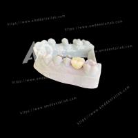 China PFM Maryland Bridge One Pontic Two Wings A Conservative and Esthetic Solution for sale