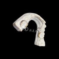 China Custom Lingual Arch with Bands Orthodontic Appliance for Space Maintenance and Dental Alignment for sale