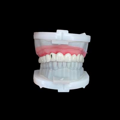 China Full Arch Implant Bridge with High-Strength CoCr Metal Framework and Premium Porcelain Layering for Precision Fit for sale