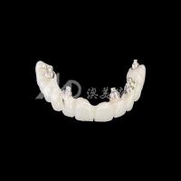 China Full Arch Implant Bridge with High-Strength CoCr Metal Framework and Premium Porcelain Layering for Precision Fit for sale