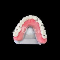 China Full Arch Implant Bridge with High-Strength CoCr Metal Framework and Premium Porcelain Layering for Precision Fit for sale