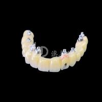 China Porcelain-Fused-to-Metal (PFM) Screw-Retained Implant Bridge for sale